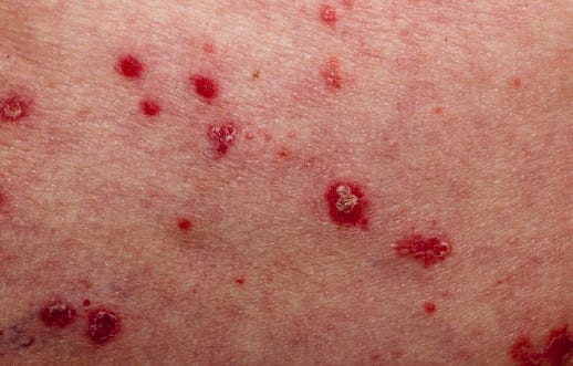 5 Tips to Banish Psoriasis Flare-Ups | Water's Edge Dermatology