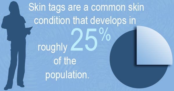 Skin Tags: Learn More | Water's Edge Dermatology