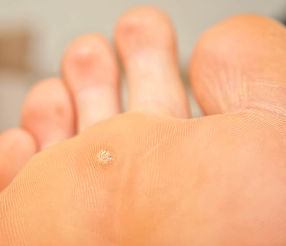 What Are Warts? - Water's Edge Dermatology
