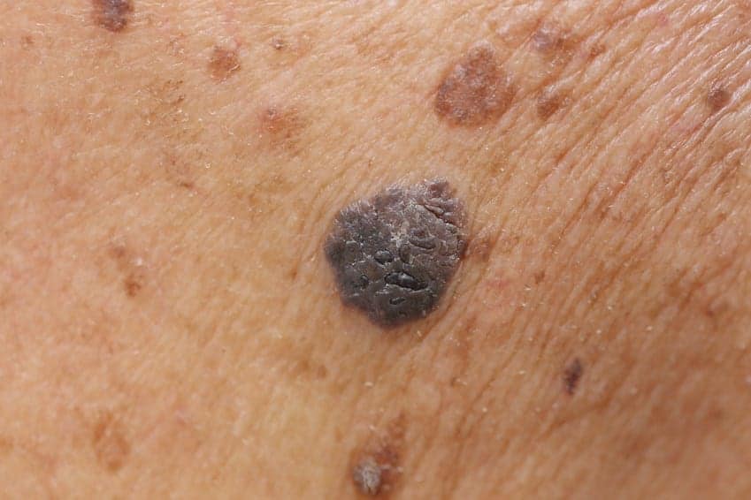 Types of Moles | Mole Treatment | Water's Edge Dermatology