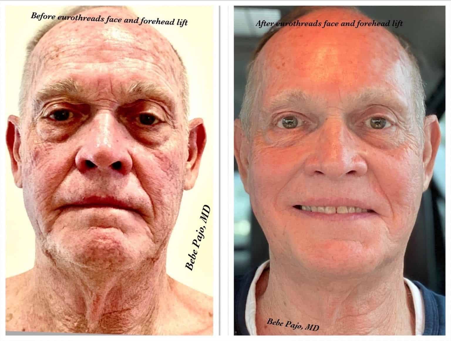 Thread Lift for Facial Rejuvenation | Water's Edge Dermatology