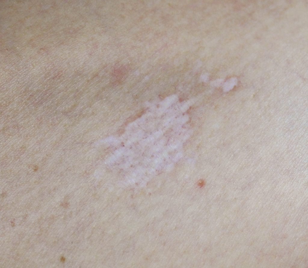 What Are the White Spots on My Skin? | Water's Edge Dermatology