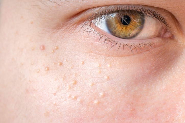 What Are the White Spots on My Skin? | Water's Edge Dermatology