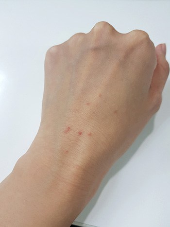 What's That Summer Skin Rash? - Water's Edge Dermatology